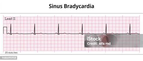 Ecg 부비동 서맥 8초 심전도 용지 빈맥에 대한 스톡 벡터 아트 및 기타 이미지 빈맥 심실 건강 진단 Istock