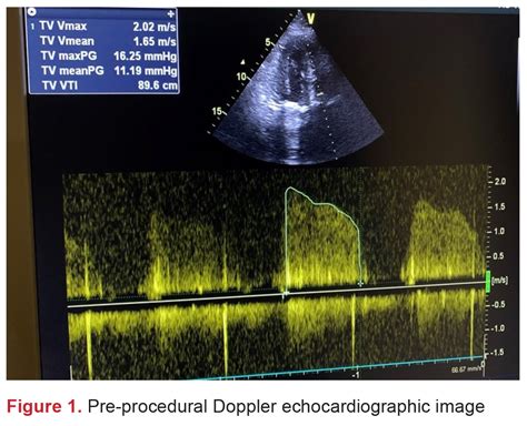 Successful Balloon Valvuloplasty In A Patient With Severe Bioprosthetic