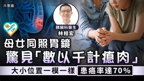 家族病史丨女兒照胃鏡嚇見「數以千計瘜肉」 大小位置與母一模一樣醫生 患癌風險達70