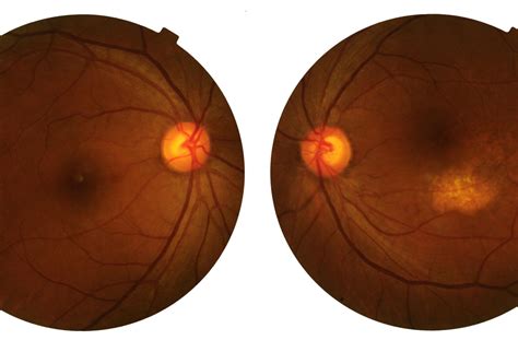 What Does Glaucoma Vision Look Like Central Optometry