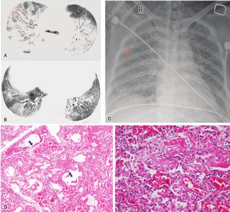 A B Large Scale Patchy Ground Glass Opacities With Consolidation And
