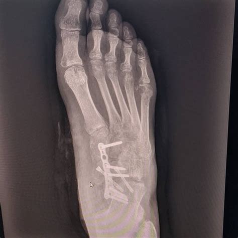 Had A Talonavicular And Navicular Cuneiform Joint Fusion R Podiatry