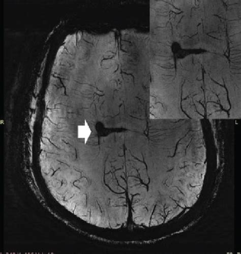 A 47 Year Old Male With Sudden Onset Of Severe Headache Tof Mra And Download Scientific