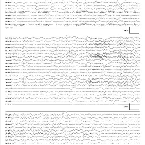 Ictal Eeg Recording Showing A Left Temporal Ictal Onset Subsequently