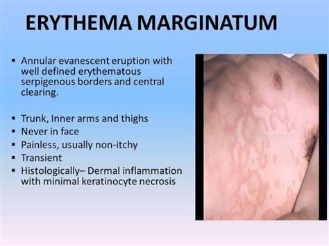 Erythema Marginatum Medical Surgical Nursing Aspirants