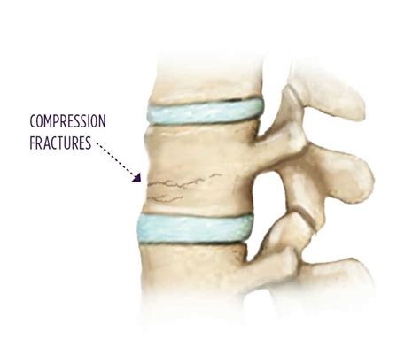Compression Fracture Lumbar