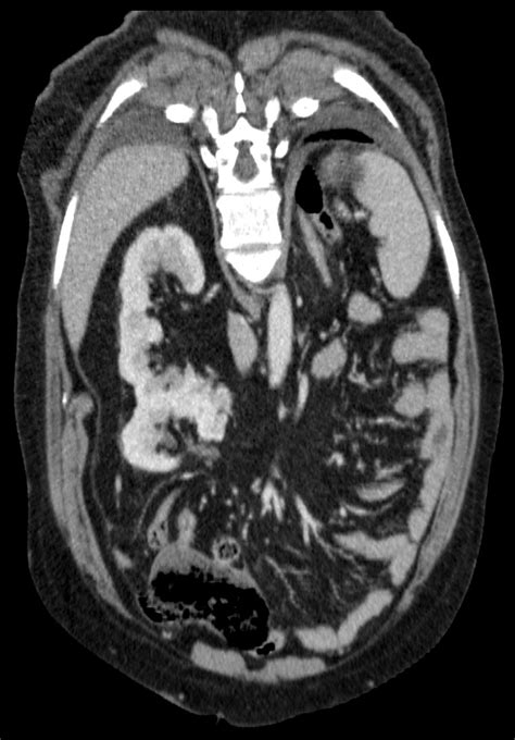 Fused Crossed Renal Ectopia At April Langdon Blog