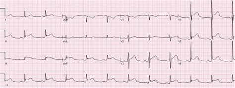 Diffuse Ste In Leads I Ii Iii Avf V2 V6 With St Depression In Leads