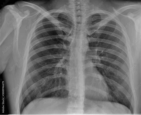 Chest X Ray Pneumonia Emphysema Pulmonology Diagnosis Of Diseases