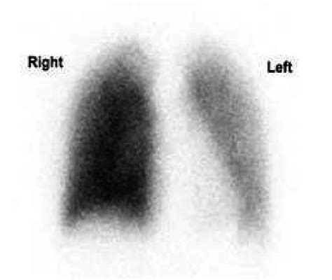 Quantitative Lung Perfusion Scan Of A Patient With Moderately Severe