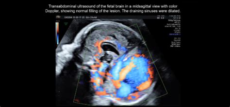 Uog Videoclip Antenatal Dural Sinus Malformation Of Torcular Herophili And Straight Sinus With
