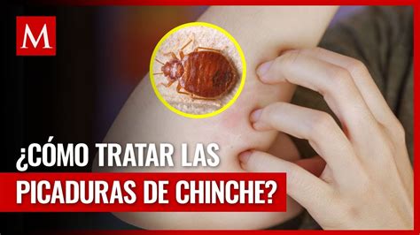 Remedios Caseros Efectivos Para Picaduras De Chinches Stop Chinches