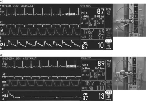 Two Methods Of Icp Monitoring And Csf Drainage A Monitor Icp