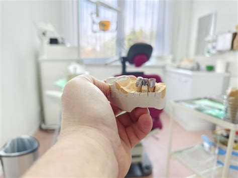 Metal Dental Bridge On Display In The Dental Office Stock Photo Image