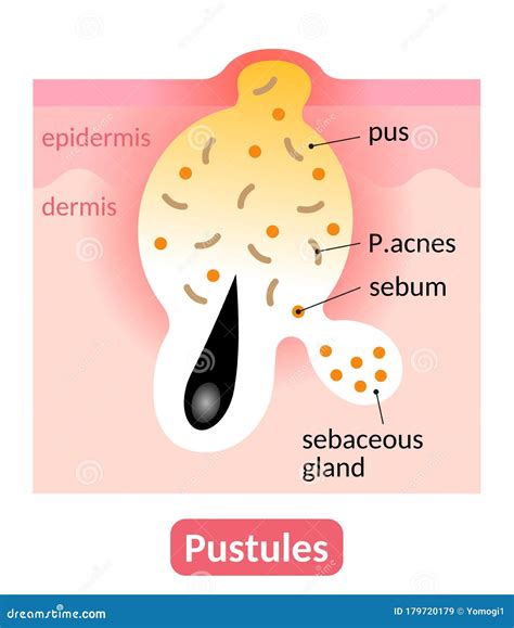 Pus Stock Illustrations Pus Stock Illustrations Vectors