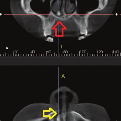 Computed Tomography Of The Osteoma With Actinomycosis In The Nasal