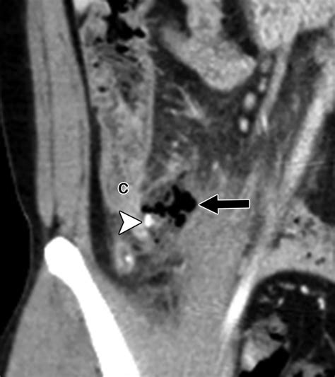 Ct Predictors Of Unfavorable Clinical Outcomes Of Acute Right Colonic