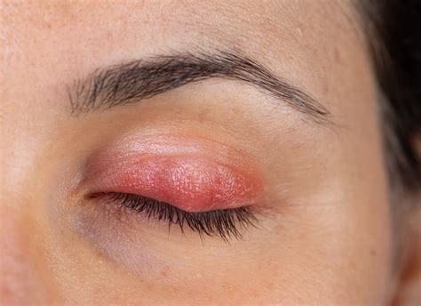 How Long Does Blepharitis Take To Go Away Balmonds