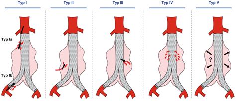 Implantable Pressure Sensing Devices For Monitoring Abdominal Aortic