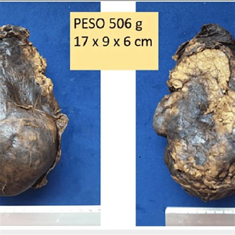Macroscopic Illustration Of The Nephrectomy Specimen A Anterior And Download Scientific