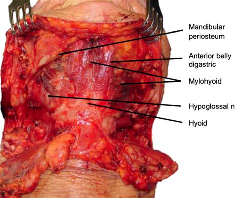 138 Total Glossectomy For Tongue Cancer Medicine Libretexts