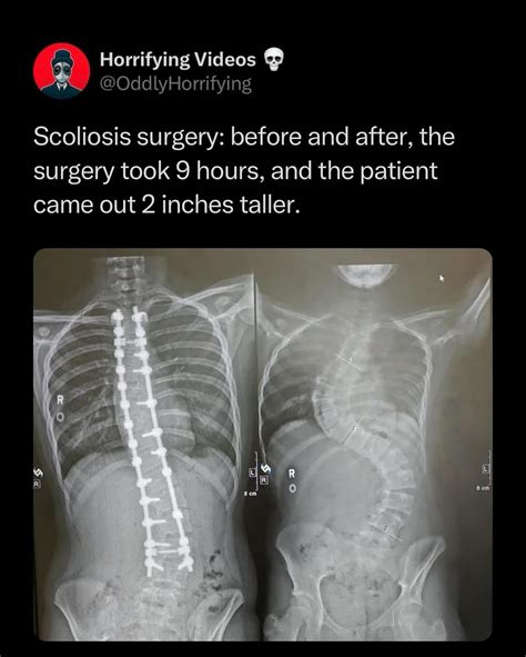 Scoliosis Surgery Before And After The Surgery Took 9 Hours And The