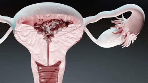 Cancer Uterus Surgery Over 953 Royalty Free Licensable Stock