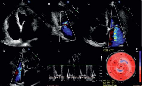 Transthoracic Echocardiography A Apical Four Chamber View Left