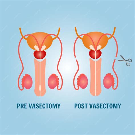 Premium Vector Medical Picture Male Reproductive System In Vector