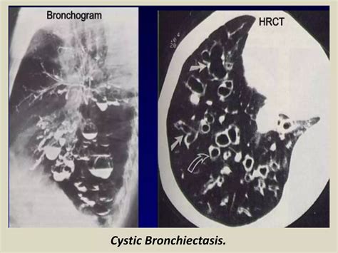 Presentation1 Pptx Radiological Imaging Of Bronchiectasis Pptx