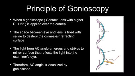 Gonioscopy By Dr Zaw Min Htet Ophthalmologist Pptx