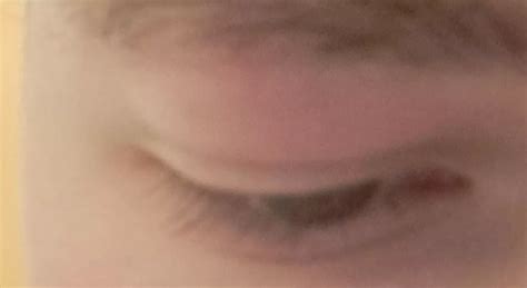 Popped A Pimple On My Eyebrow Now It Got Swollen And Its Pushing Down