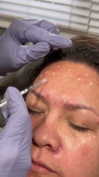 Botox Injection Frontalis Muscle In The Forehead 1 Unit Per Injection Site Youtube