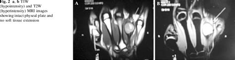 A B T1w Hypointensity And T2w Hyperintensity Mri Images Showing