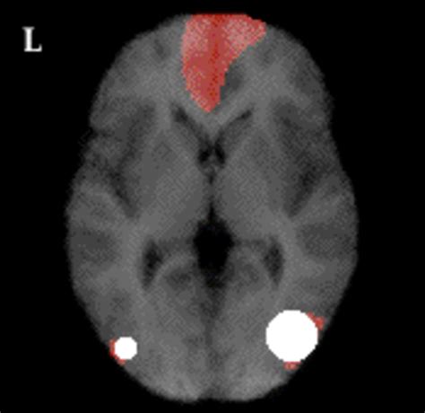 Within Modality Auditory Priming Statistical Parametric Maps Spm