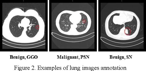 figure 1 from automatic lung nodule classification in ct images using