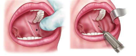 Inferior Alveolar Nerve Block Dentamasters