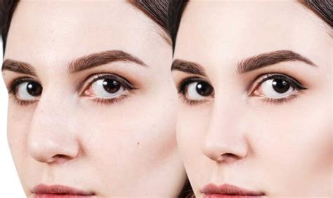 Rhinoplasty Surgery Doctors In Bhubaneswar Nose Reshaping Clinic