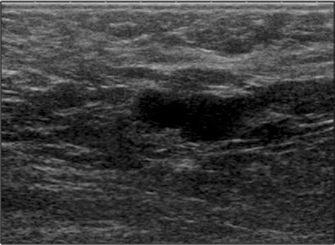 Sonographically Metastatic Axillary Lymph Node Image In A 40 Year Old