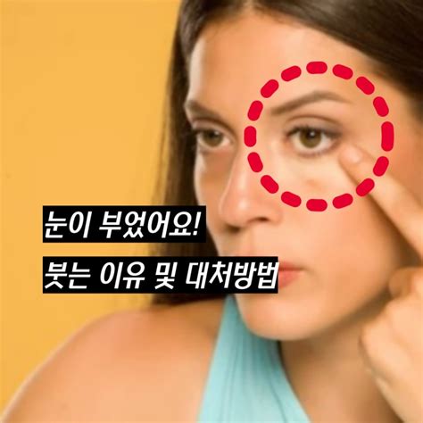 눈이 부었어요 붓는 이유 및 눈 부음 해소방법 네이버 블로그