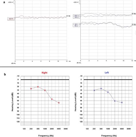 Pre And Postoperative Audiologic Information Of Case 1 A Preoperative Download Scientific