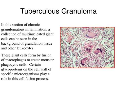 PPT Periapical Granuloma PowerPoint Presentation ID 4604077