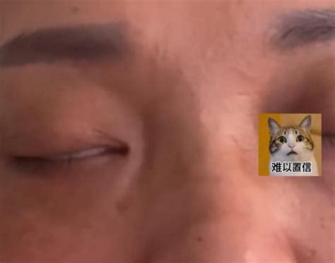 关于3000块祛眼袋后眼睑闭合不全洗脸时眼睛进水事件陈长永有话说 知乎