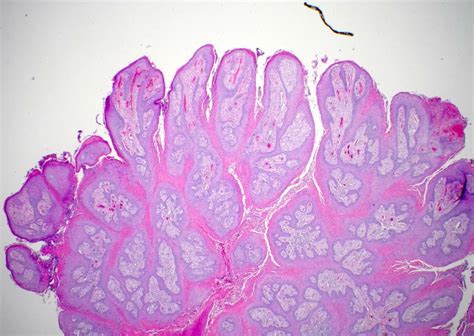 Jerad Gardner Md On Twitter Rt Jmgardnermd Polypoid Scrotal Lesion