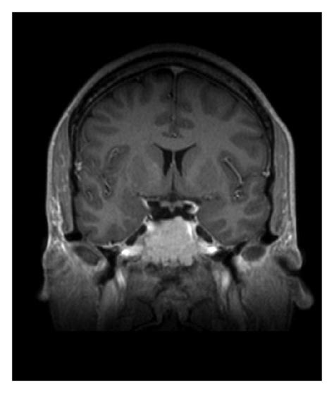 Preoperative Magnetic Resonance Imaging With Contrast Axial A