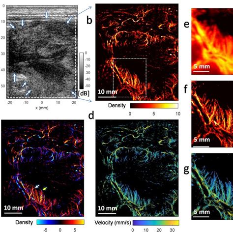 Pdf Super Resolution Ultrasound Localization Microscopy Based On A High Frame Rate Clinical