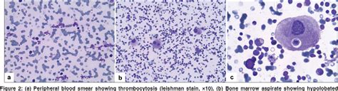 Figure 1 From Preneoplastic And Neoplastic Megakaryocyteplatelet