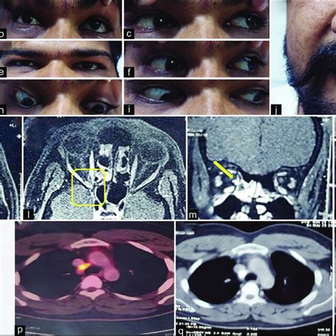 Etiologies Of Third Cranial Nerve Palsy Based On Anatomical