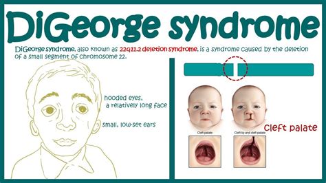 Velocardiofacial Syndrome
