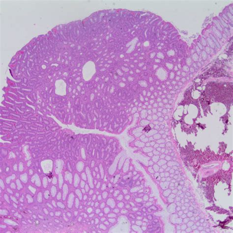 Gross Appearance Of The Large Bowel In Sessile Serrated Lesion Polyp